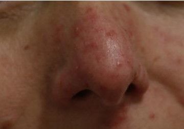 Růžovka není růžová zahrada, ale onemocnění jménem rosacea.